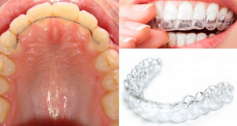 Ortodoncia: La importancia de los retenedores - Dentaden
